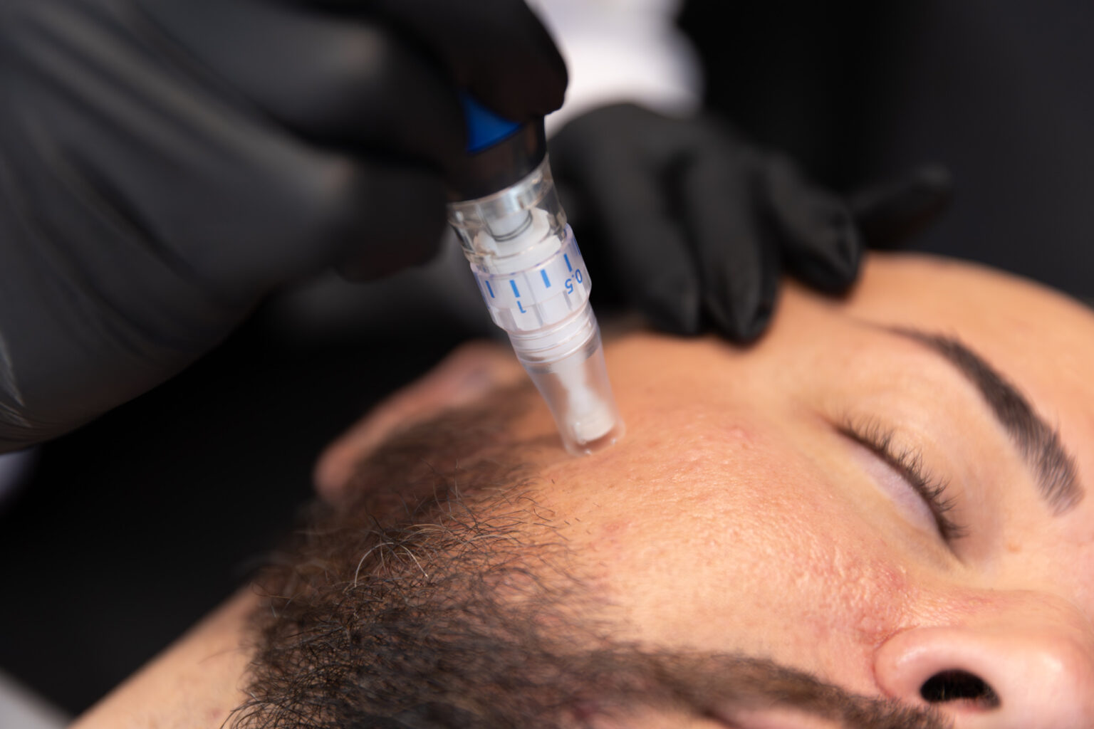 Microneedling in Memphis | Glo Medical Aesthetics