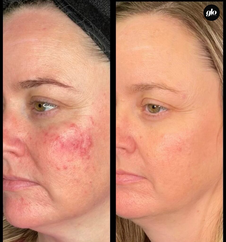Before & After Archive - Glo Medical Aesthetics